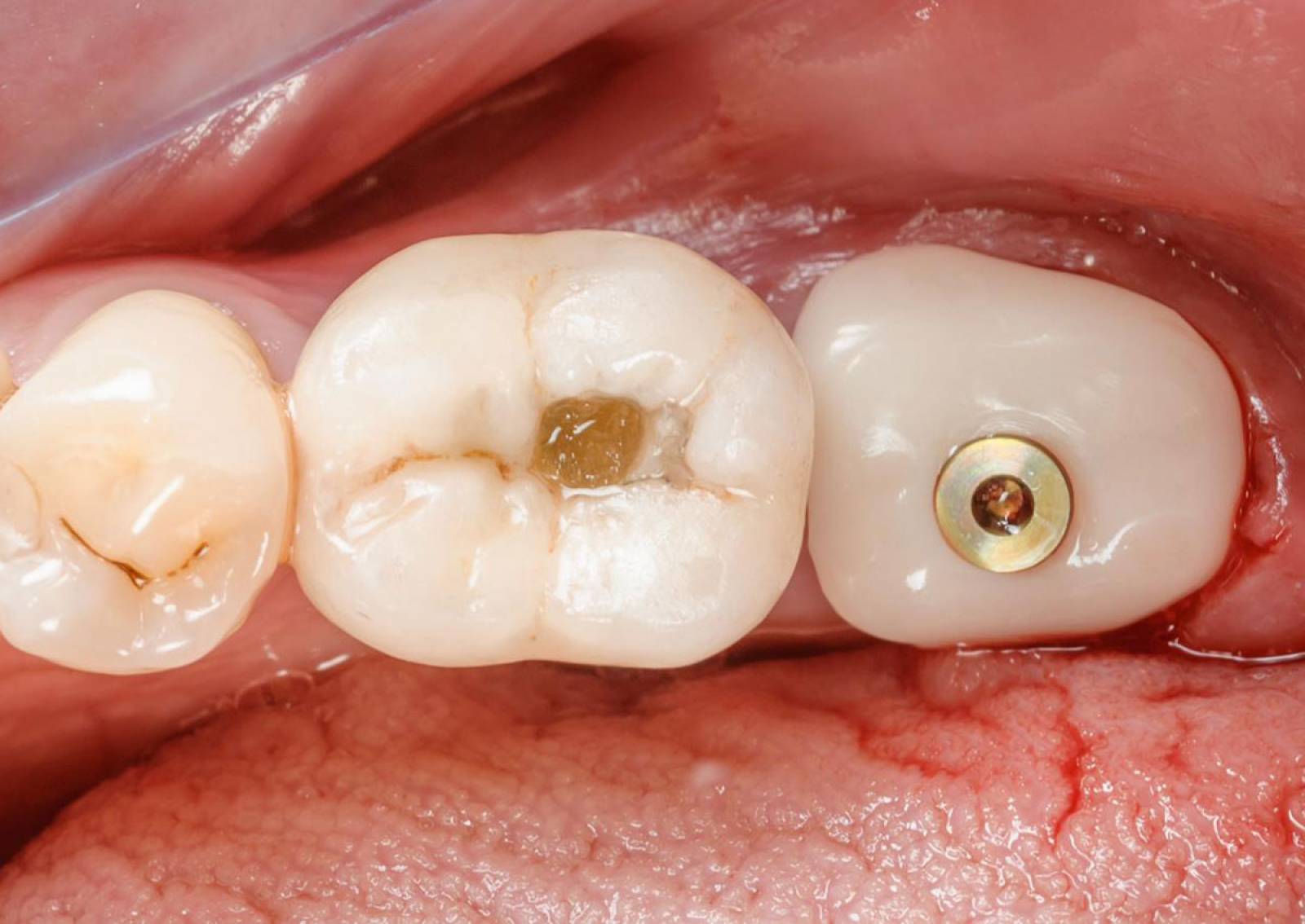 Matrix Digital Implant - Adm1stchoicemedicals