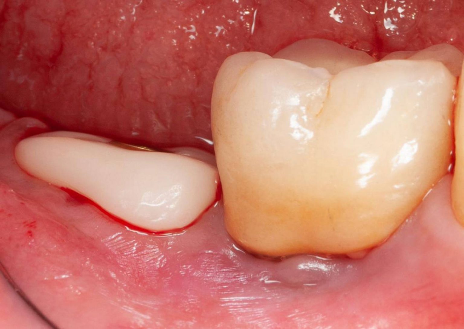 Matrix Digital Implant - Adm1stchoicemedicals