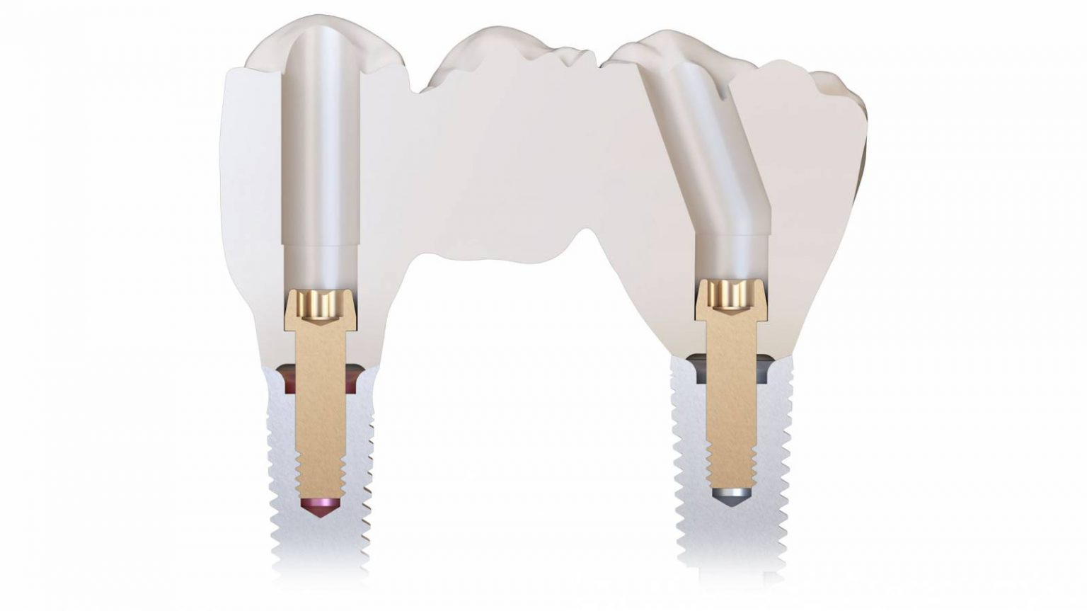 Matrix Digital Implant - Adm1stchoicemedicals