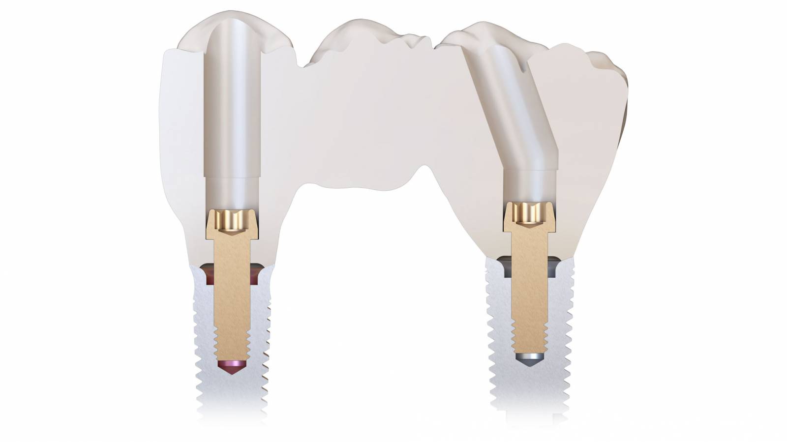 Matrix Digital Implant - Adm1stchoicemedicals